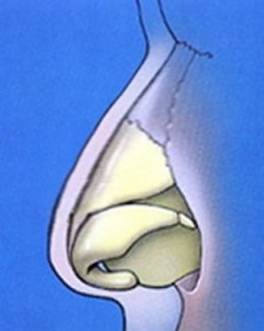 Nasal Pollybeak Deformity And Rhinoplasty | Dr. Hilinski