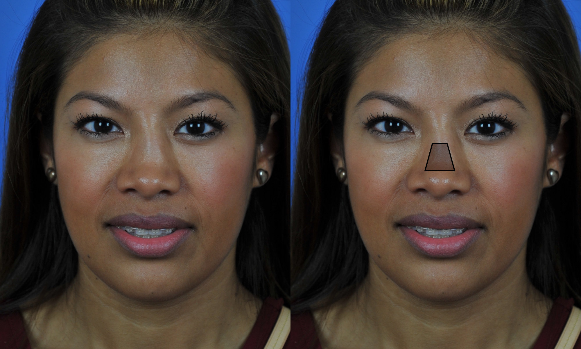 Rhinoplasty Surgery for Saddle Nose Deformity in San Diego, CA | Dr ...