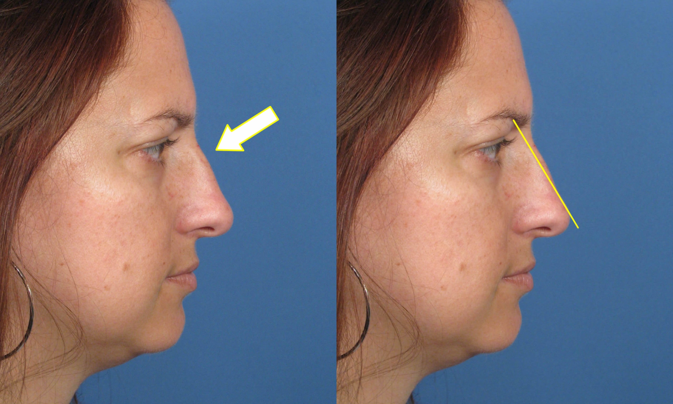 Preserving the Overall Facial Appearance in Rhinoplasty | Dr. Hilinski