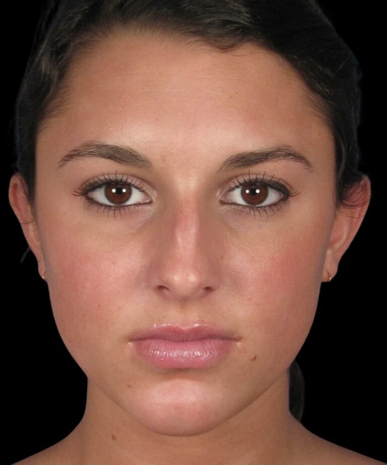 Facial Plastic Surgery San Diego, CA | John Hilinski MD