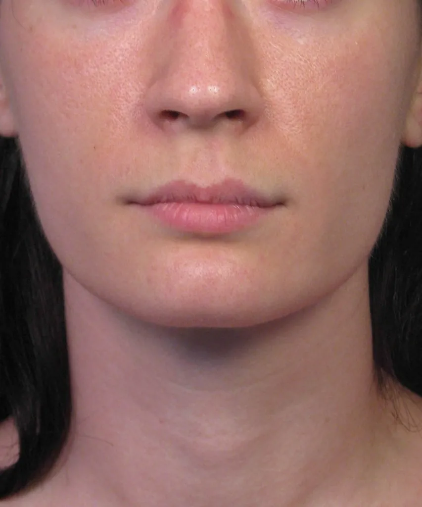 Subnasale Upper Lip Lift Case Example San Diego CA
