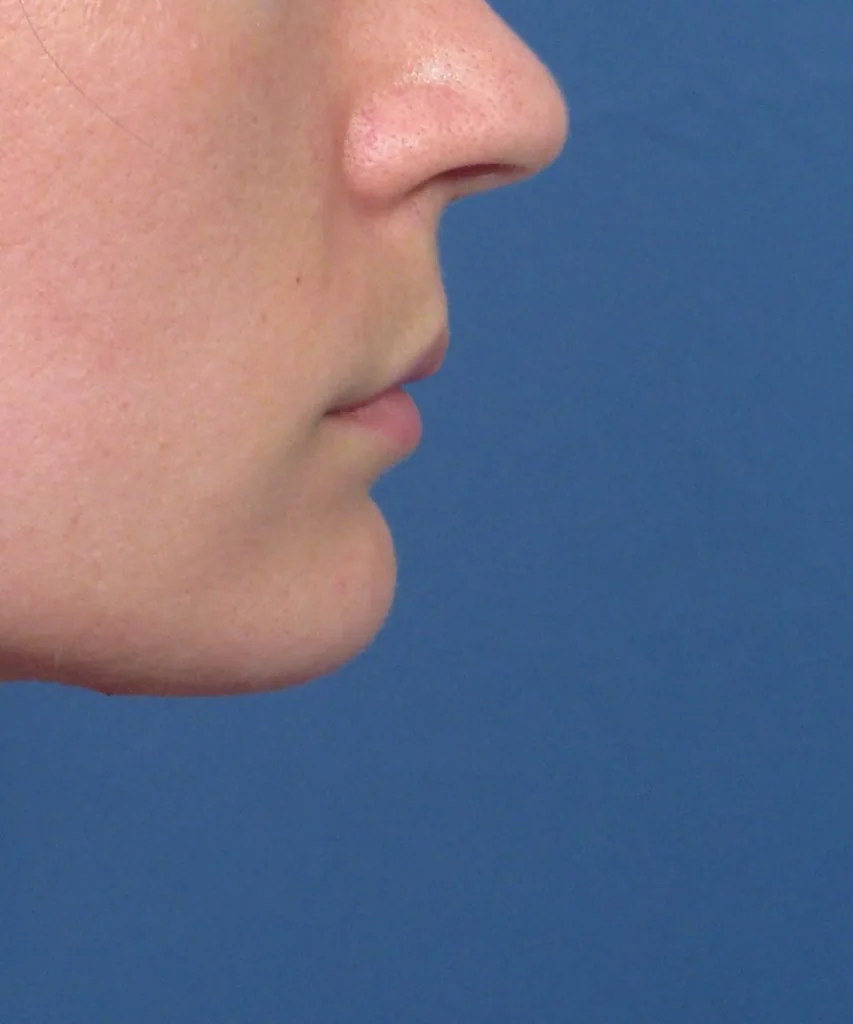 Subnasale Upper Lip Lift Case Example San Diego CA