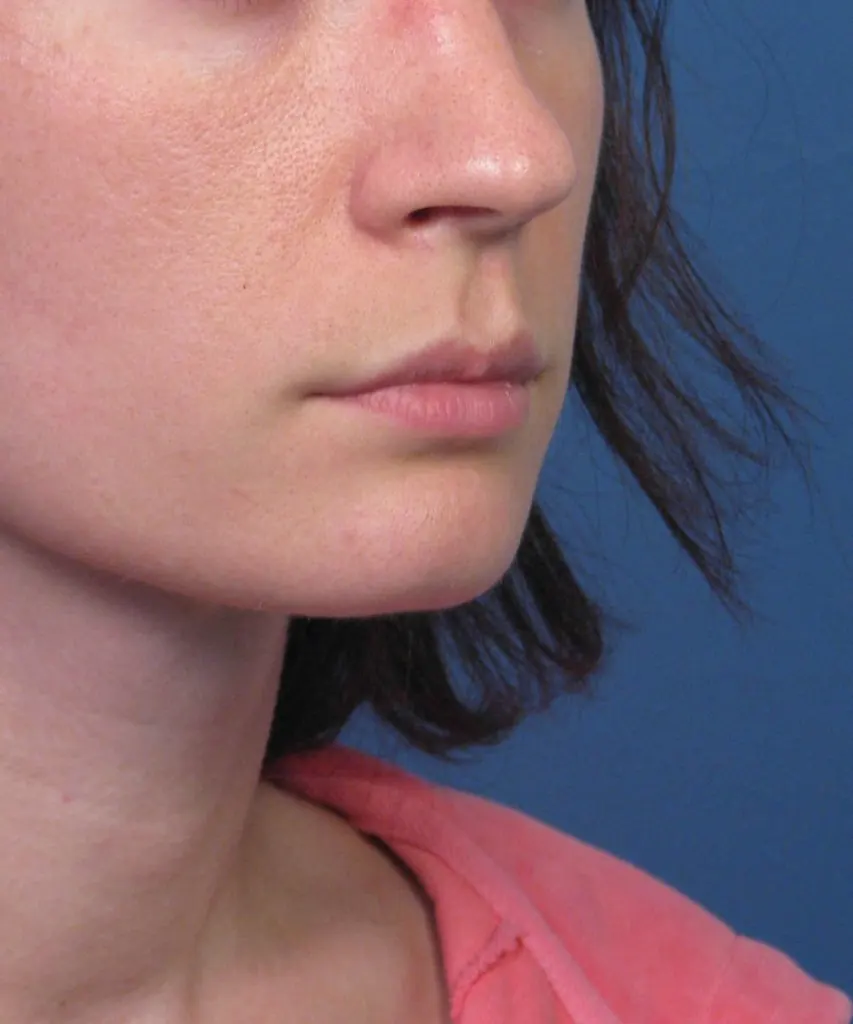 Subnasale Upper Lip Lift Case Example San Diego CA