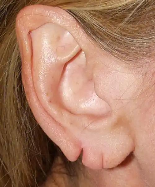 Earlobe Reshaping in San Diego CA