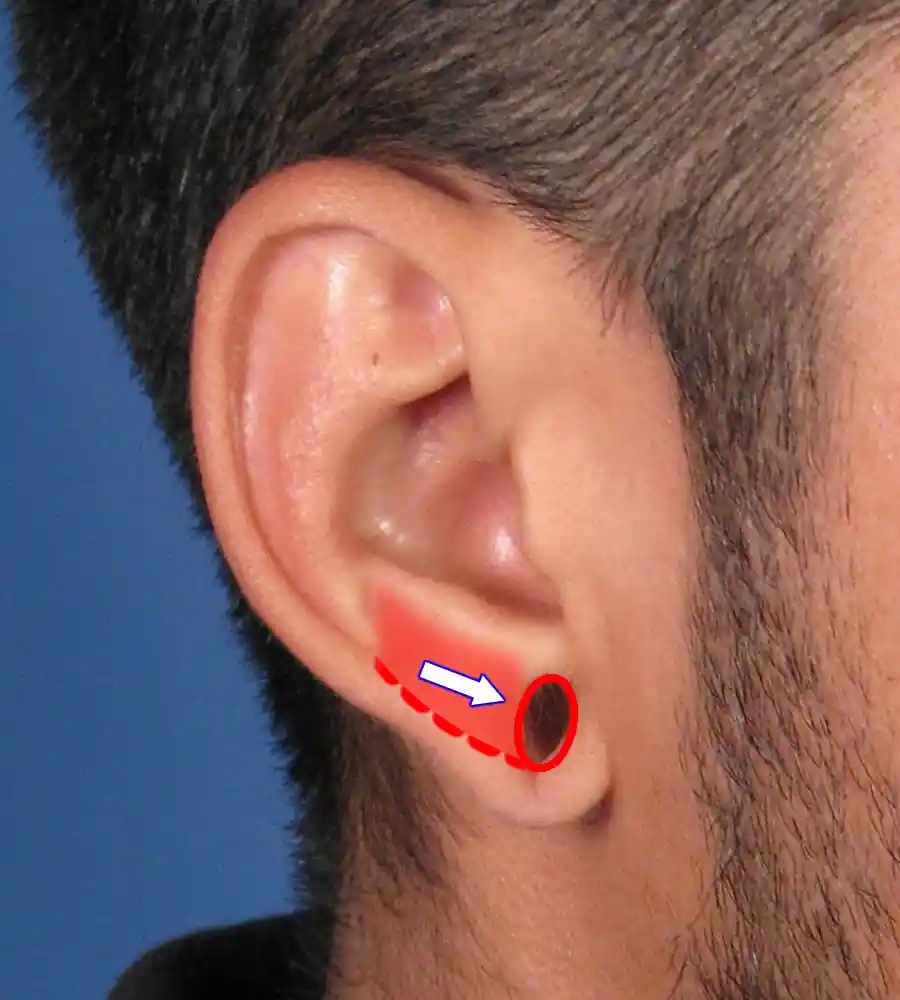 Gauge Torn Earlobe Repair San Diego CA