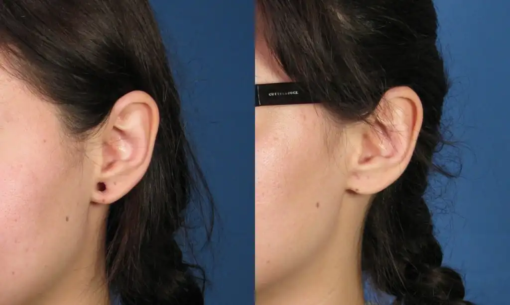 Gauge Torn Earlobe Repair San Diego CA