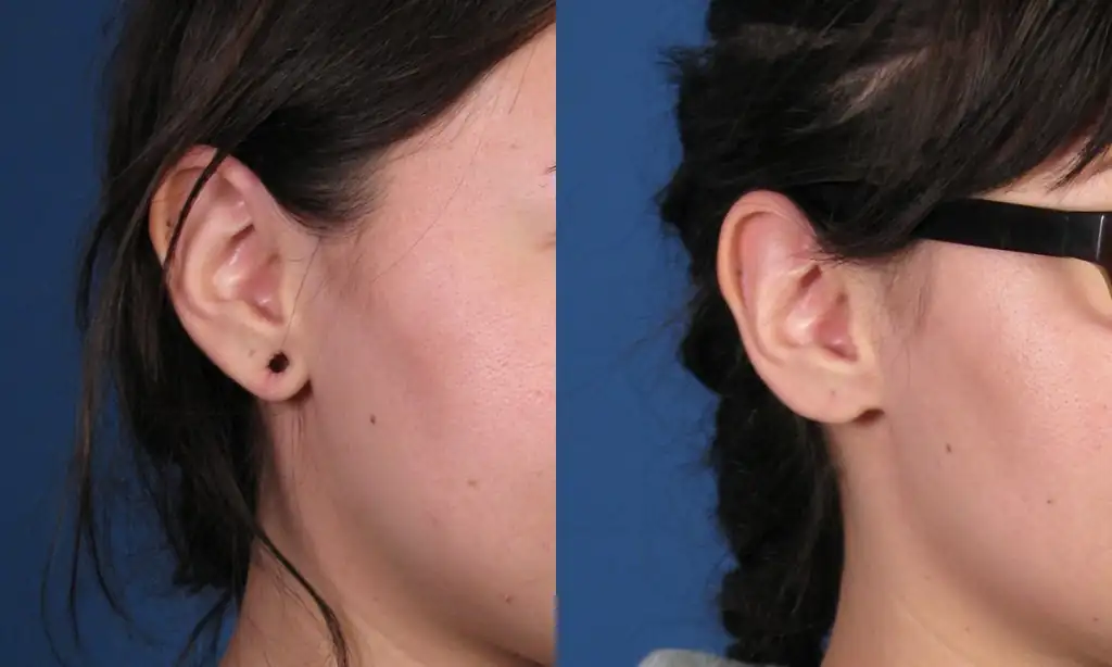Gauge Torn Earlobe Repair San Diego CA