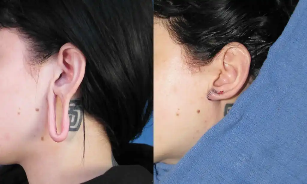 Gauge Torn Earlobe Repair San Diego CA