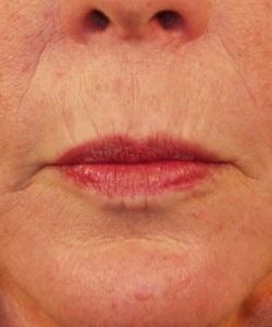 Upper Lip Lift Shortening San Diego CA