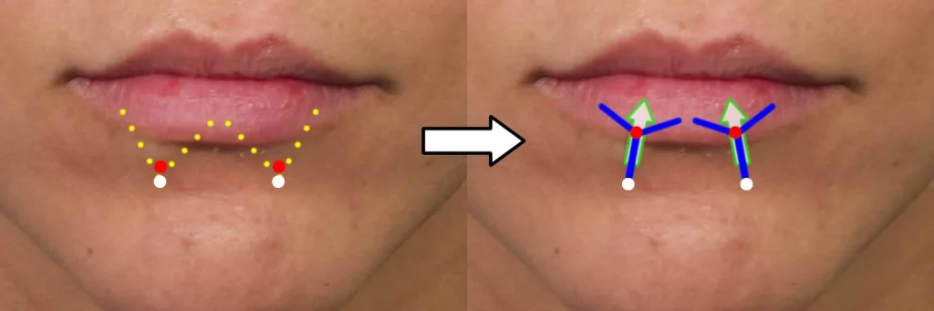 Permanent Lower Lip Advancement San Diego CA