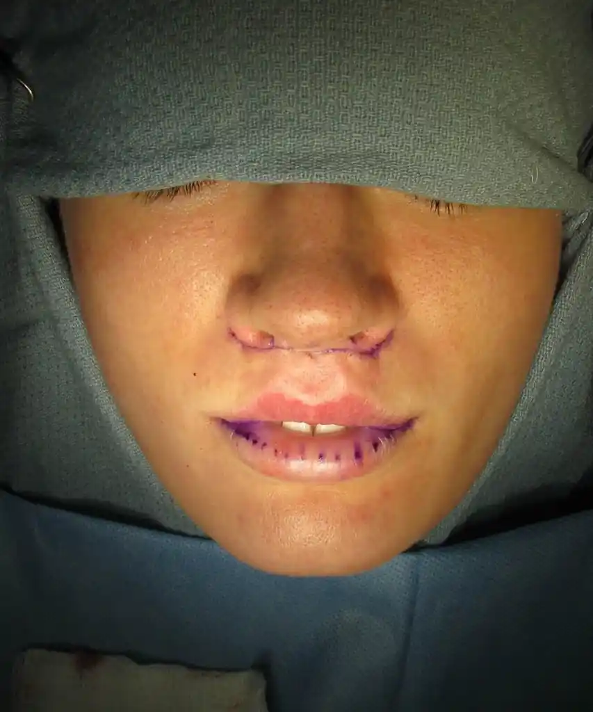 Subnasale Upper Lip Lift Case Example San Diego CA