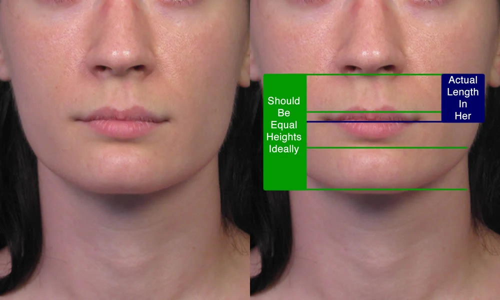 Subnasale Upper Lip Lift Case Example San Diego CA