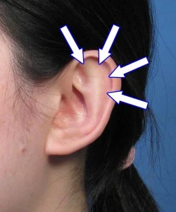 Macrotia Ear Reduction Surgery San Diego CA