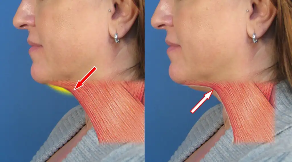 Case Study of Neck Liposuction Plastysmaplasty in San Diego, CA