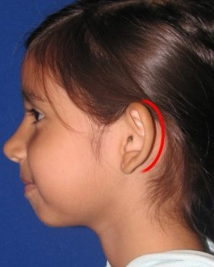 Ear Reduction Surgery Otoplasty San Diego CA