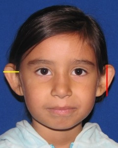 Ear Reduction Surgery Otoplasty San Diego CA