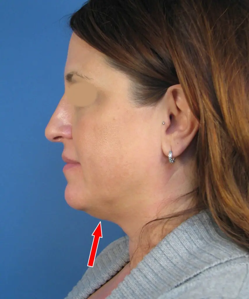 Case Study of Neck Liposuction Plastysmaplasty in San Diego, CA