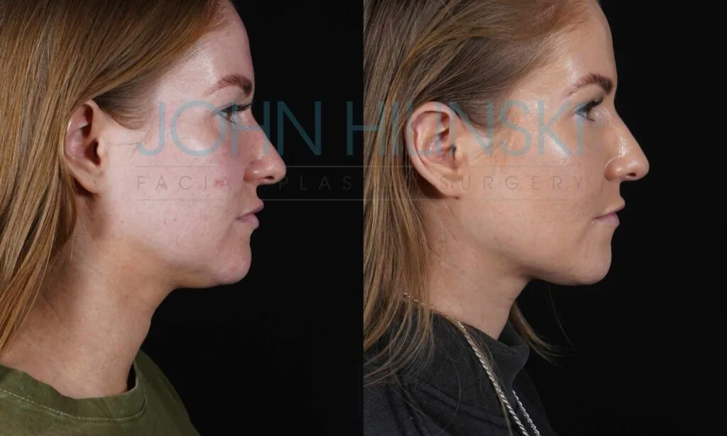 Profound RF Non-Surgical Skin Tightening and Cellulite Treatment in San ...