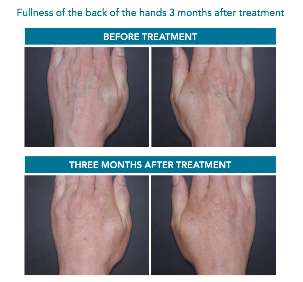 Radiesse Hand