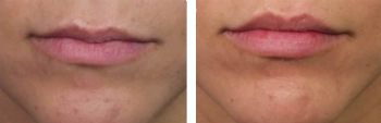Permanent Lower Lip Advancement San Diego CA