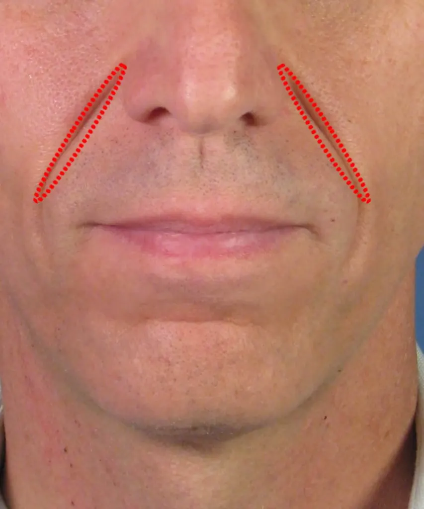 Smile Line Treatment San Diego CA