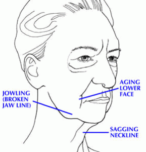 San Diego Facelift Surgery | Mini Face Lift La Jolla, CA