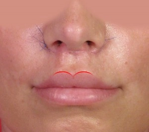 Upper Lip Lift Shortening San Diego CA