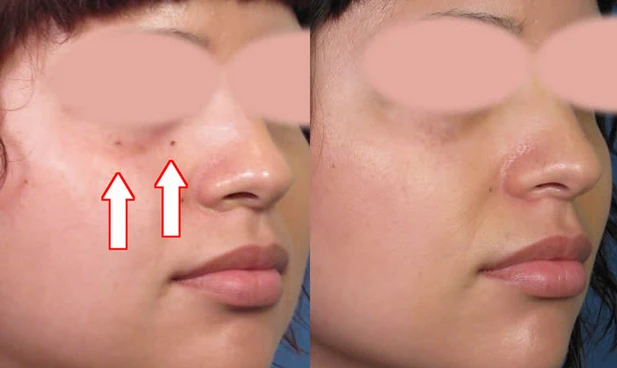 Facial Mole Removal San Diego CA