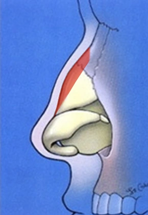 Preservation Rhinoplasty San Diego | Natural-Looking Nose Surgery