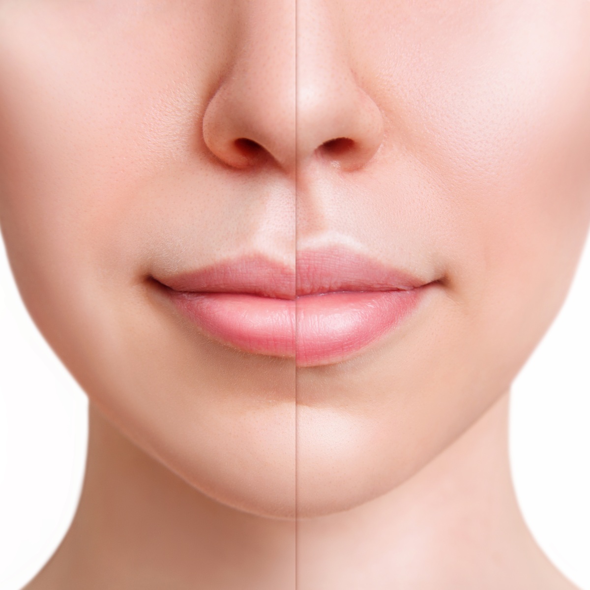 San Diego CA Lip Injections | La Jolla Lip Plumping, Volume