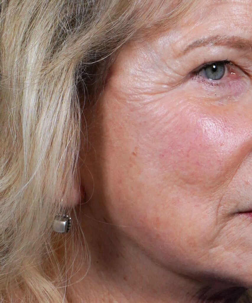 San Diego CA Cosmetic Laser Treatments | La Jolla MedSpa Laser Procedures