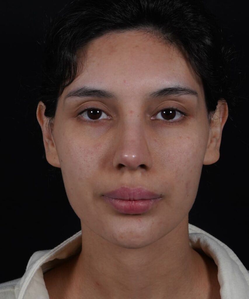 San Diego CA Macrotia Ear Reduction Surgery | La Jolla Reduction Otoplasty