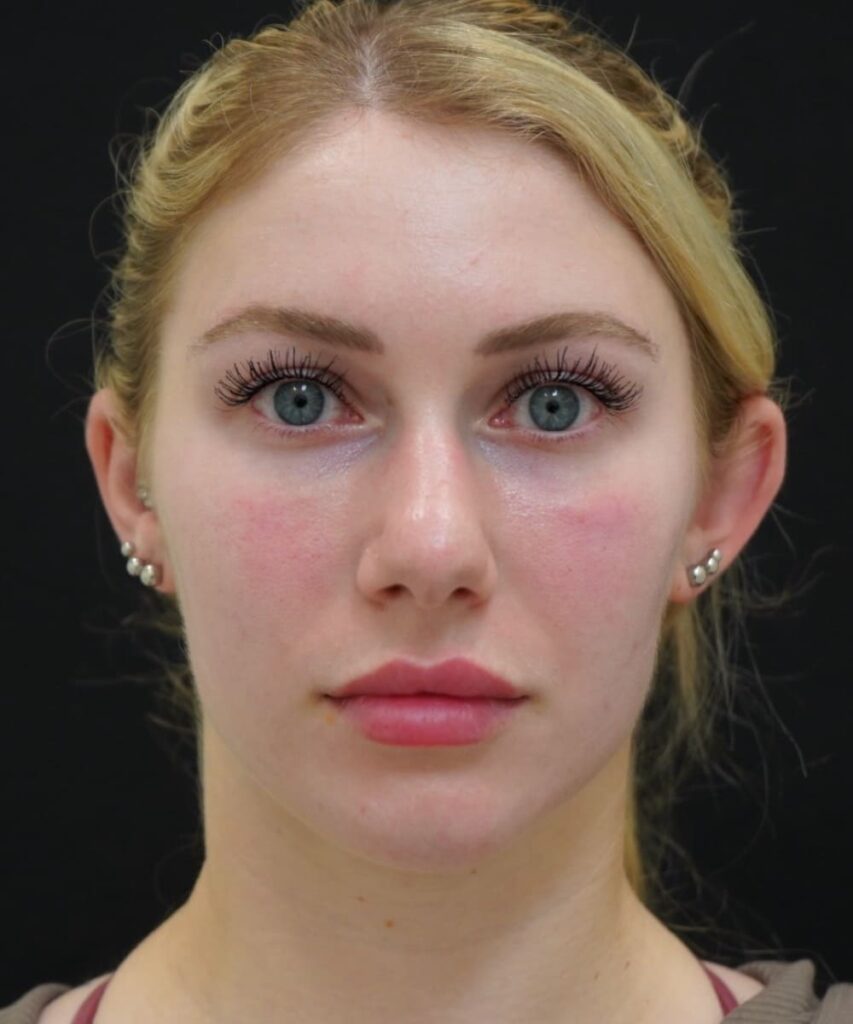 Otoplasty Archives | John Hilinski, M.D.