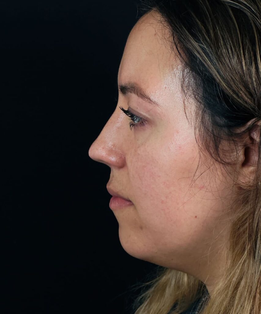 Rhinoplasty Archives | John Hilinski, M.D.