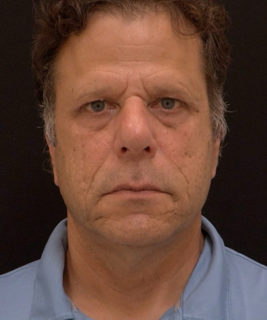 Injectable Fillers Archives | John Hilinski, M.D.