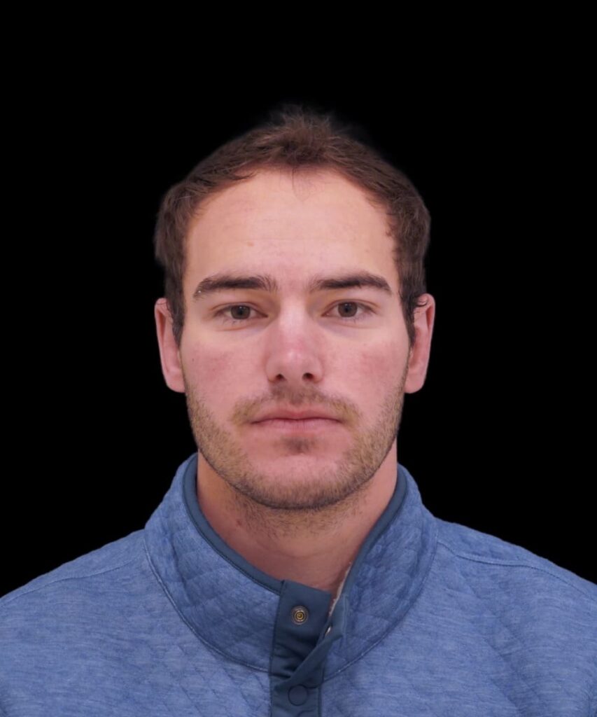 Otoplasty Archives | John Hilinski, M.D.