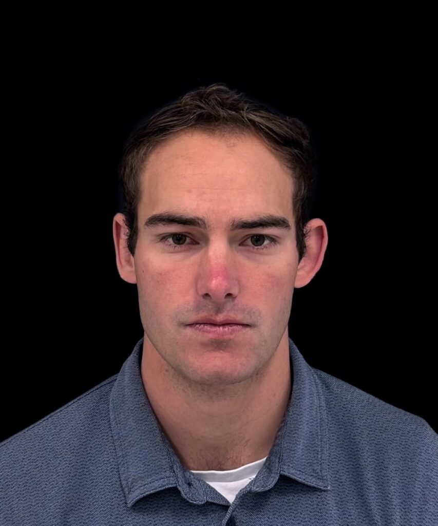 Otoplasty Archives | John Hilinski, M.D.