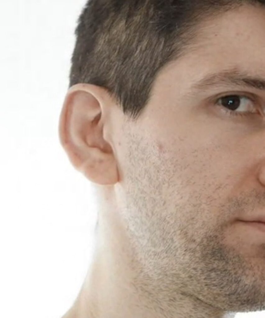 John Hilinski MD Plastic Surgery Patient Gallery in San Diego