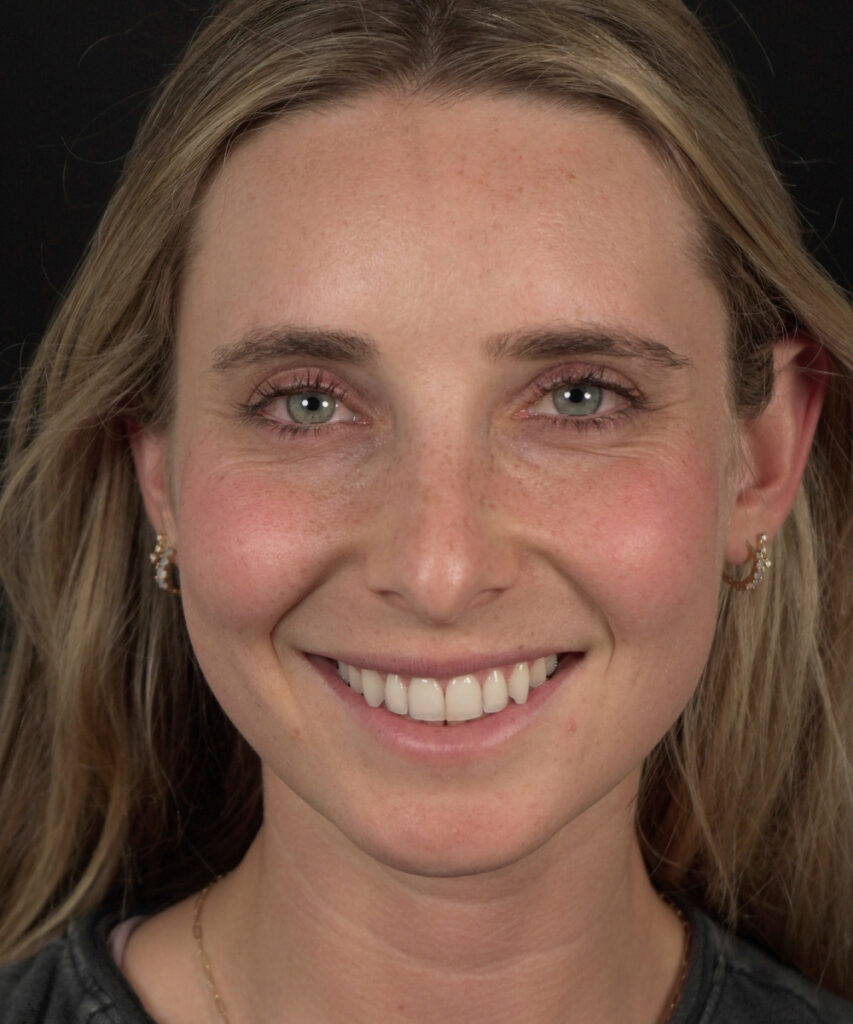 Rhinoplasty Archives | John Hilinski, M.D.